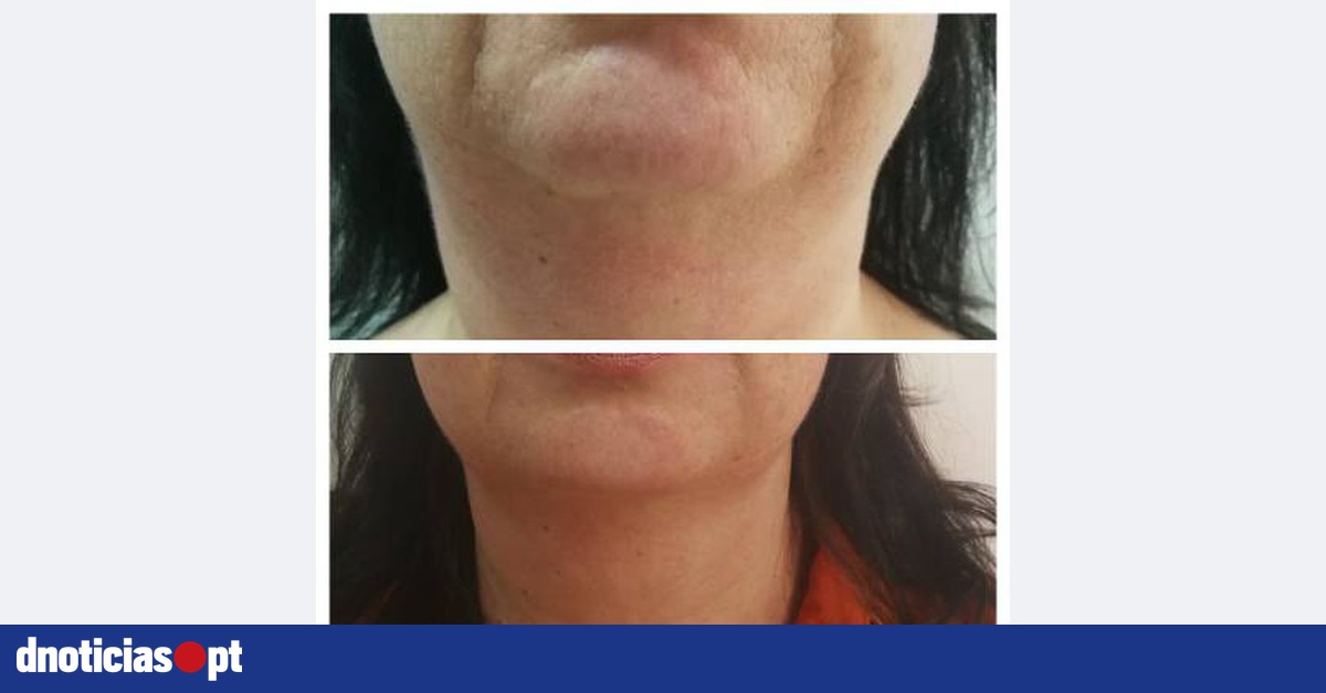 Diga Adeus ao Duplo queixo! — DNOTICIAS.PT